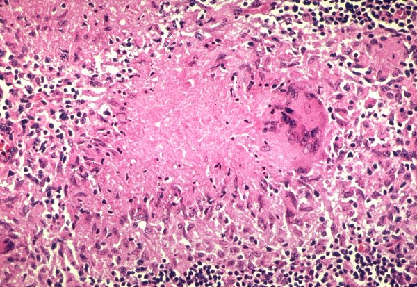 Granuloma - WikiLectures