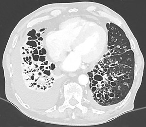 Bronchiectatic syndrome (internal propaedeutics) - WikiLectures