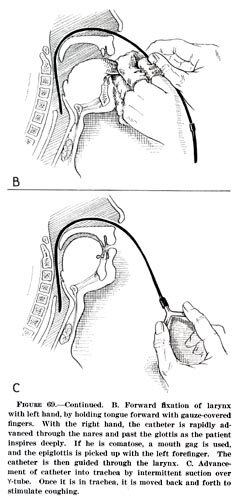 Endotracheal intubation (pediatrics) - WikiLectures