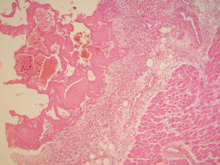 Fibrinous pericarditis (preparation) - WikiLectures