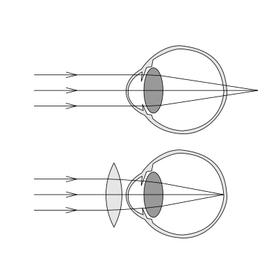Refractive defects - WikiLectures