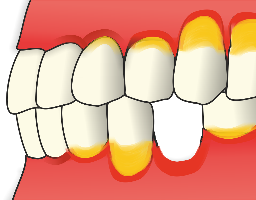 Periodontitis - WikiLectures