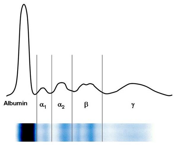 Serum protein electrophoresis - WikiLectures