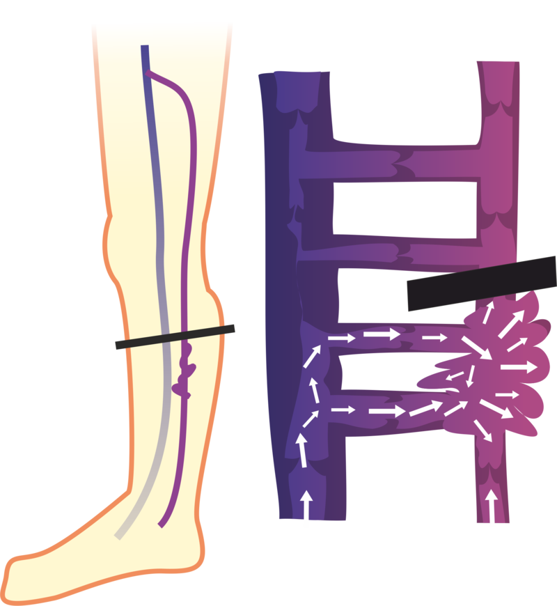 Perthes test - WikiLectures