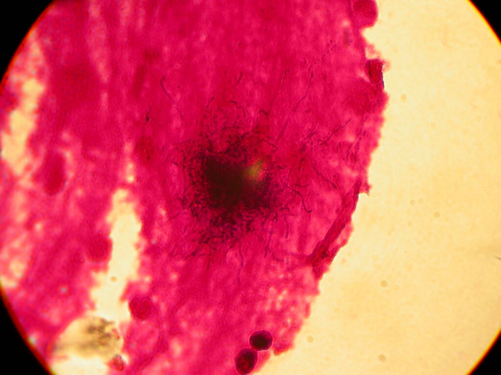 Actinomyces israeli - WikiLectures