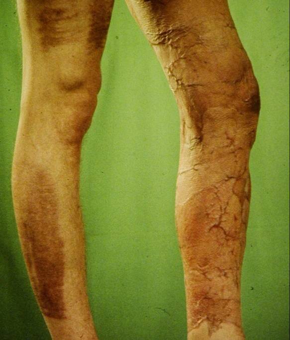 Fascial excision - WikiLectures