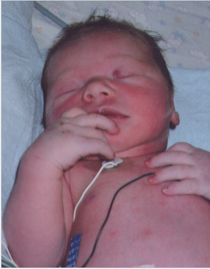 Peripheral cyanosis - WikiLectures