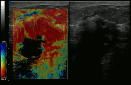 Elastography - WikiLectures