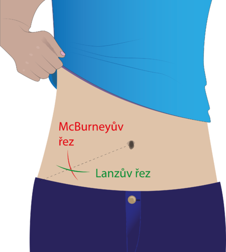 Appendicitis (pediatrics) - WikiLectures