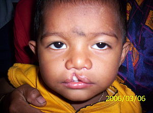Facial clefts - WikiLectures