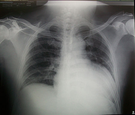 Cardiomegaly - WikiLectures