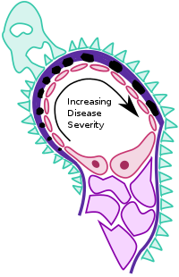 Membranous glomerulonephritis - WikiLectures