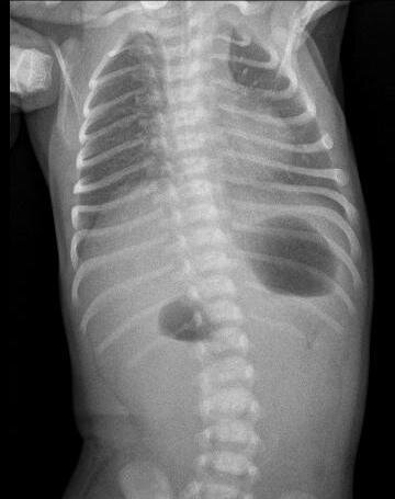 Atresia and stenoses of the small intestine - WikiLectures