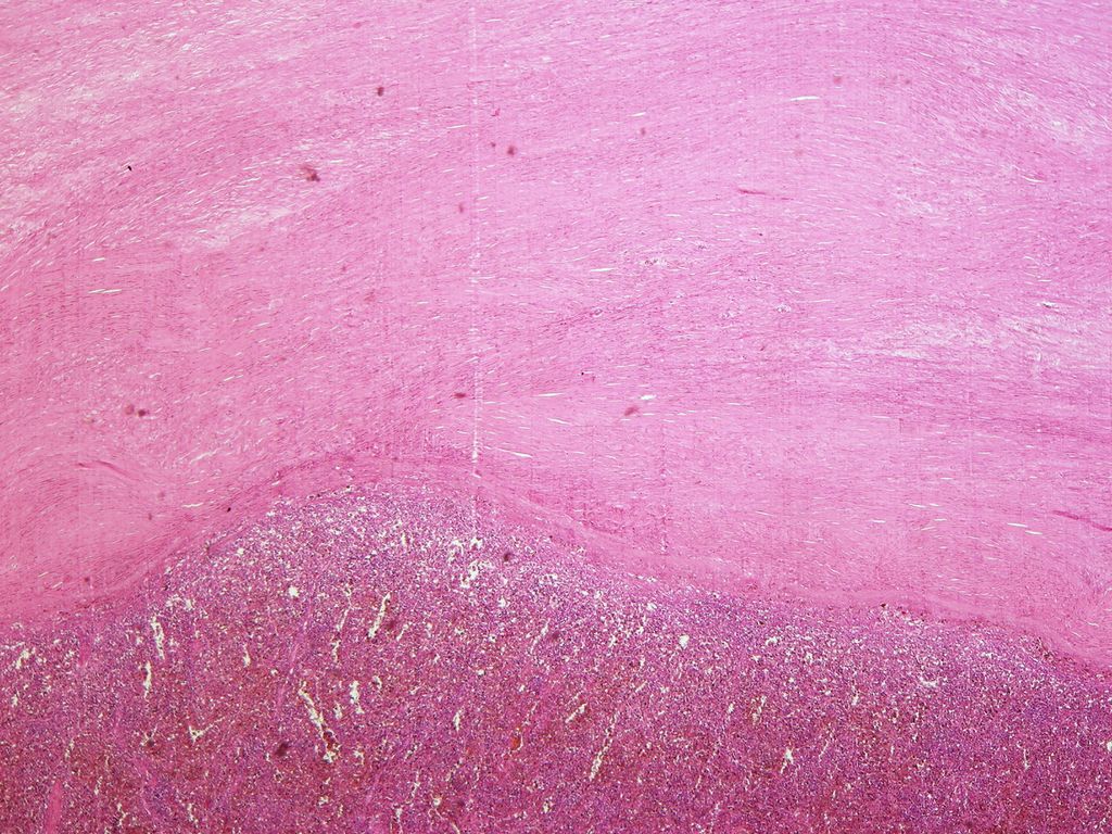 Hyaline dystrophy - WikiLectures