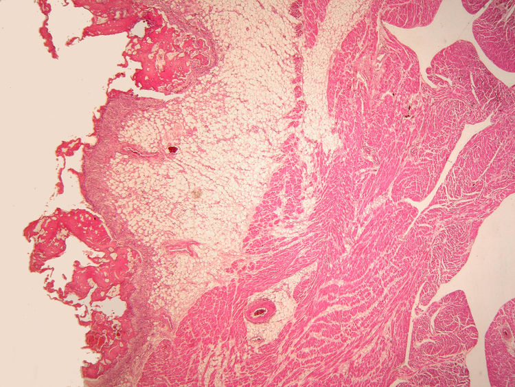 Fibrinous pericarditis (preparation) - WikiLectures