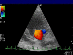 Doppler echocardiography - WikiLectures
