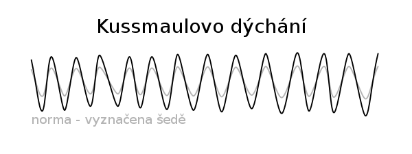 Kussmaul respiration - WikiLectures