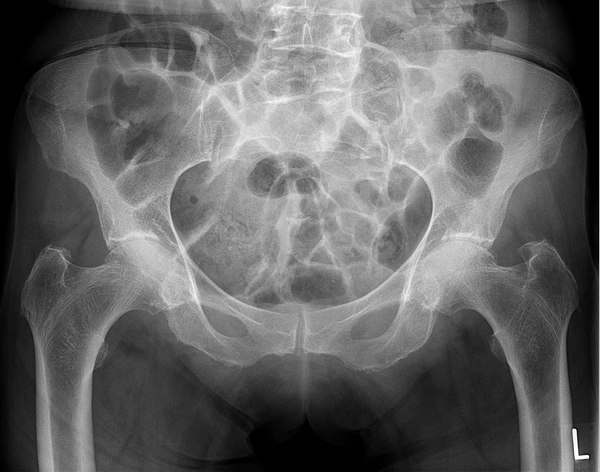 Coxa vara adolescentium - WikiLectures