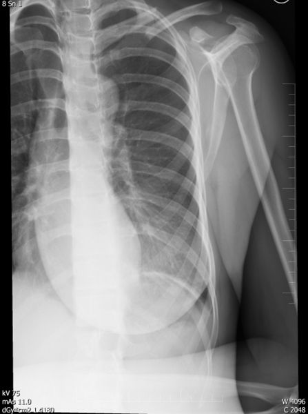 Abruption - WikiLectures