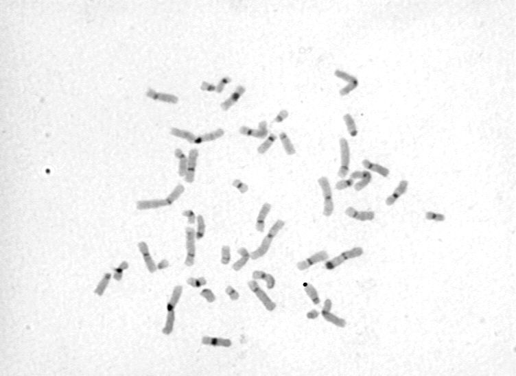 Karyotype Chromosome Chromosomal Abnormalities Numerical Chromosomes ...