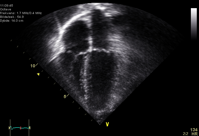 Two-dimensional echocardiography - WikiLectures
