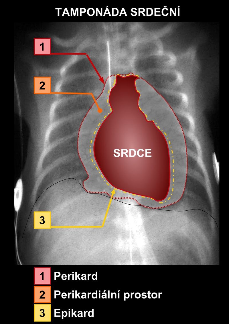 Cardiac tamponade - WikiLectures