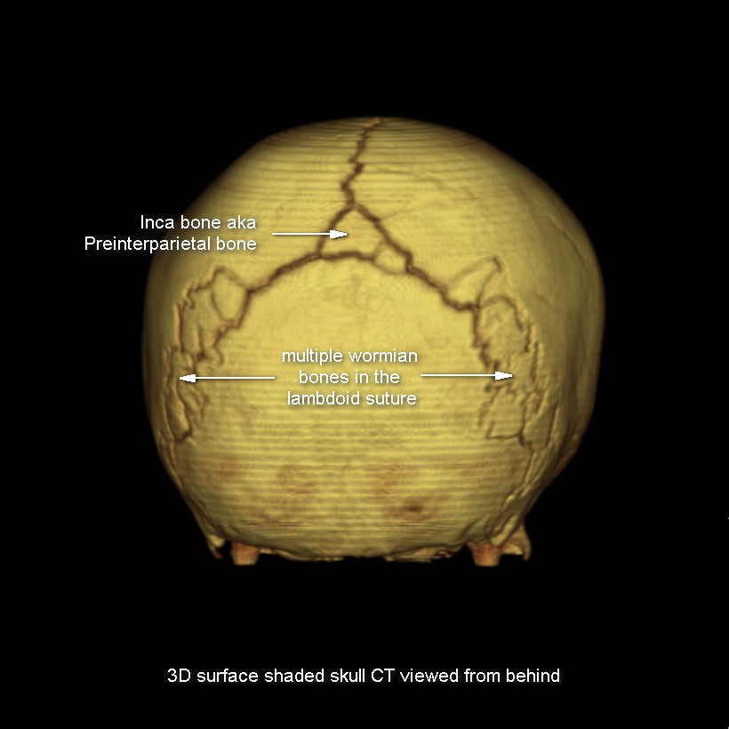 Wormian bones - WikiLectures