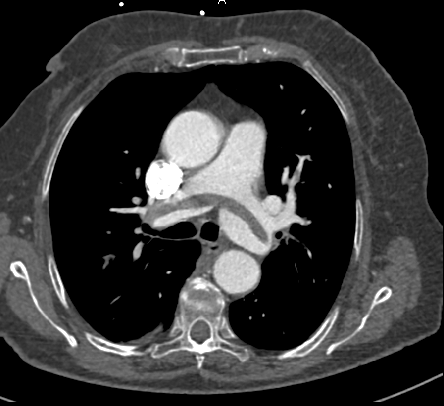 Embolism - WikiLectures
