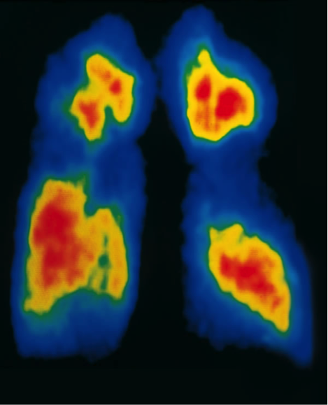 Scintigraphy - WikiLectures