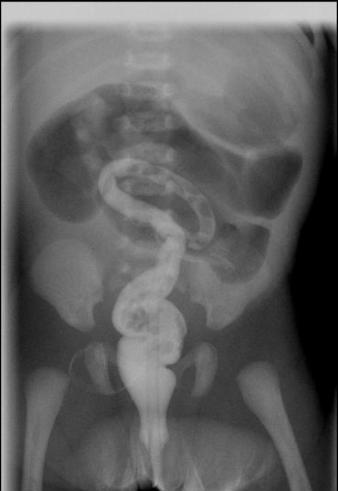 Congenital defects of the gastrointestinal tract - WikiLectures