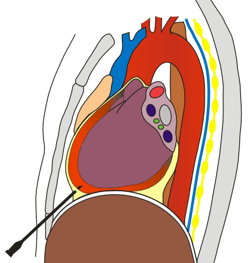 Pericardiocentesis - WikiLectures