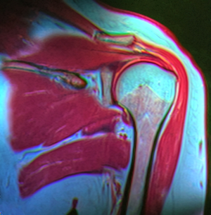 Kehr's sign - WikiLectures