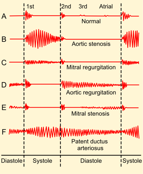 Acquired heart defects - WikiLectures