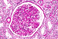 Glomerulopathy - WikiLectures