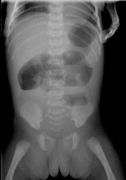 Atresia and stenoses of the small intestine - WikiLectures