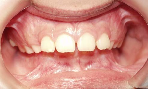 Scissor Bite - WikiLectures