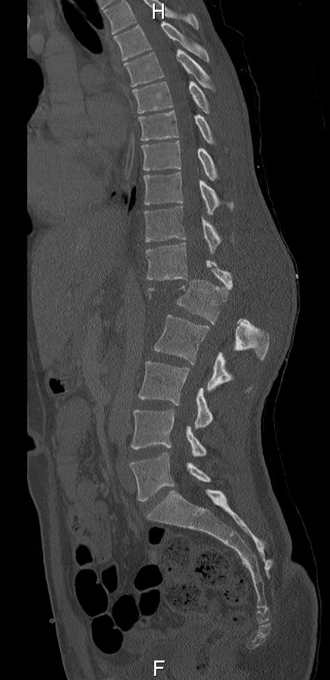 Types of fractures and their dislocations - WikiLectures