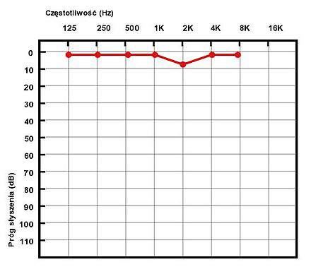 Audiometry - WikiLectures