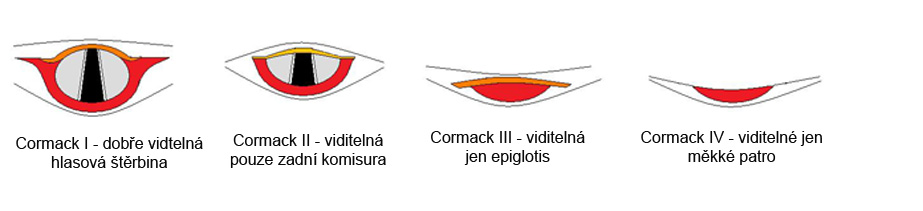 Difficult intubation - WikiLectures